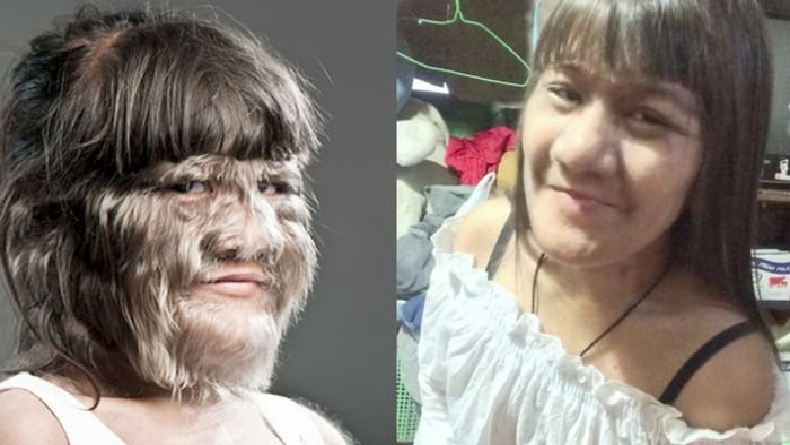 Supatra Sasuphan, Gadis Berbulu Lebat bak Serigala yang Kini Telah Menikah