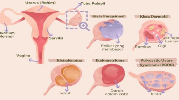 Kista: Penyebab, Gejala, Cara Mengobati, Anda Wajib Tahu!