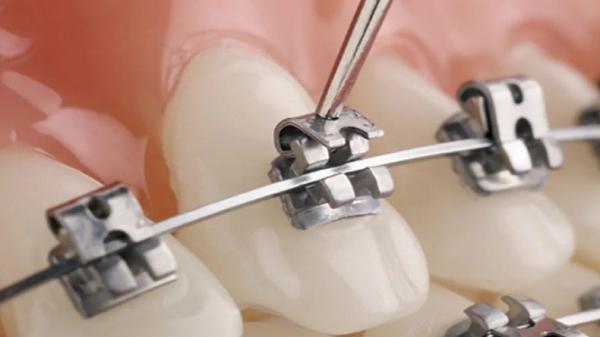 Keunggulan Pemasangan Behel Self Ligating, Tidak Hanya Minim Gesekan