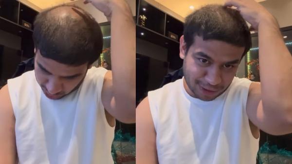 Heboh Fadil Jaidi Alami Kebotakan karena Bleaching Rambut, Kenali ...