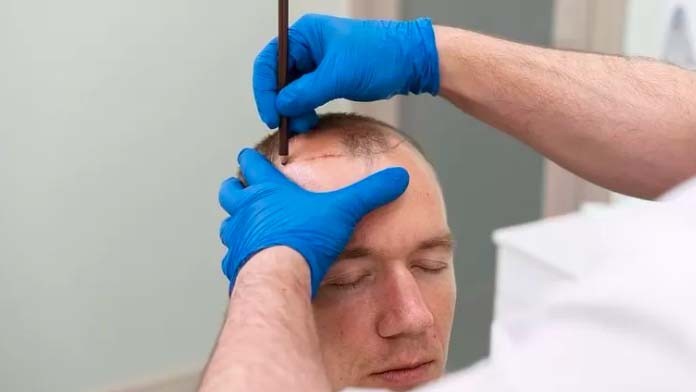 Benarkah Transplantasi Rambut Solusi untuk Masalah Kebotakan, Begini ...