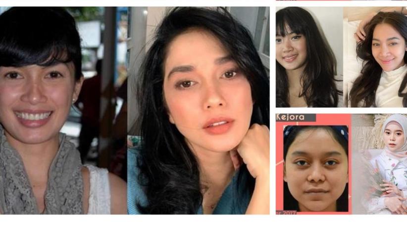Ini Penampilan Artis Sebelum Dan Sesudah Tanam Benang Lesti Kejora