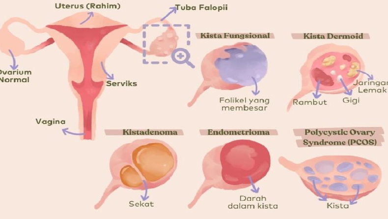 Kista: Penyebab, Gejala, Cara Mengobati, Anda Wajib Tahu!