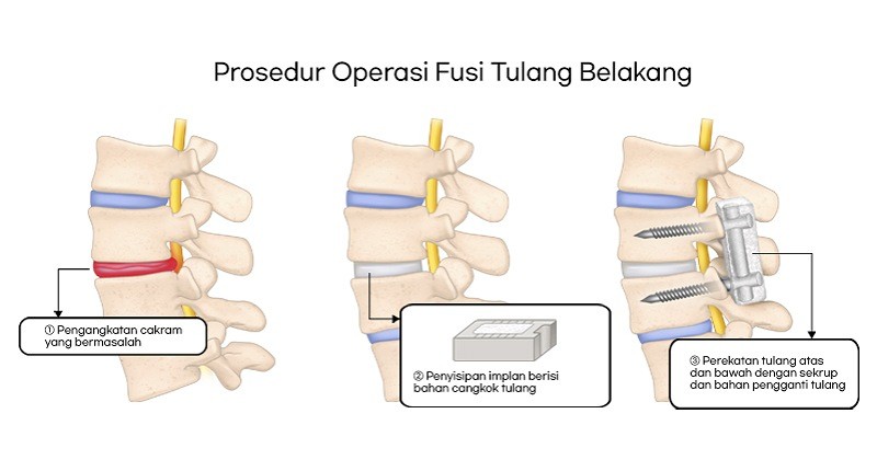 Jangan Sepelekan Gangguan Tulang Belakang, Kenali Cara Penyembuhannya!