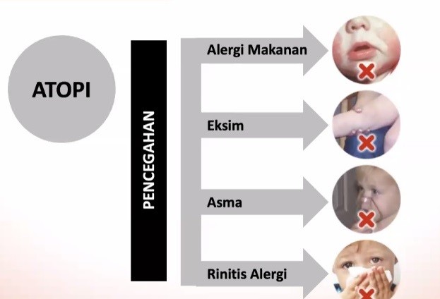 Ciri-Ciri Anak Alergi Susu Sapi, Jangan Anggap Sepele Begini Dampaknya